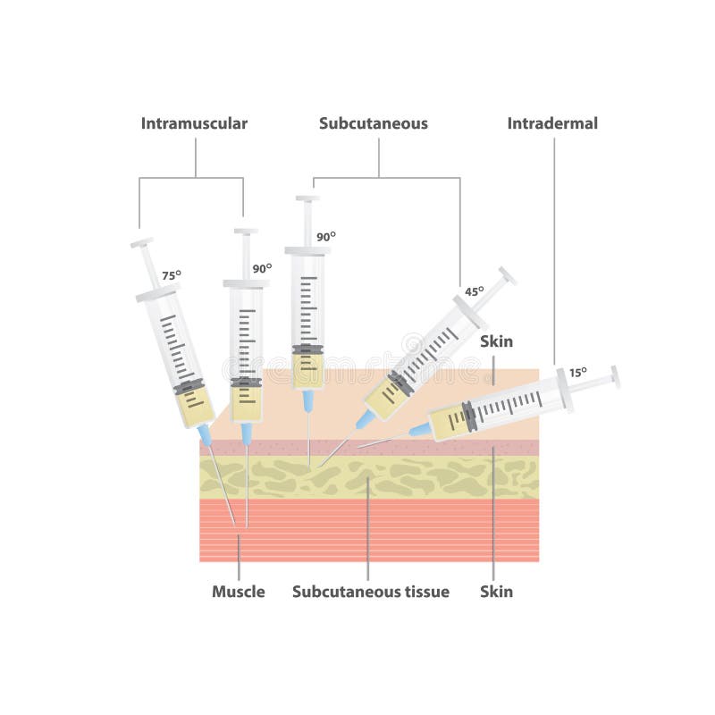 Intramuscular Injection and Subcutaneous Injection Stock Vector ...