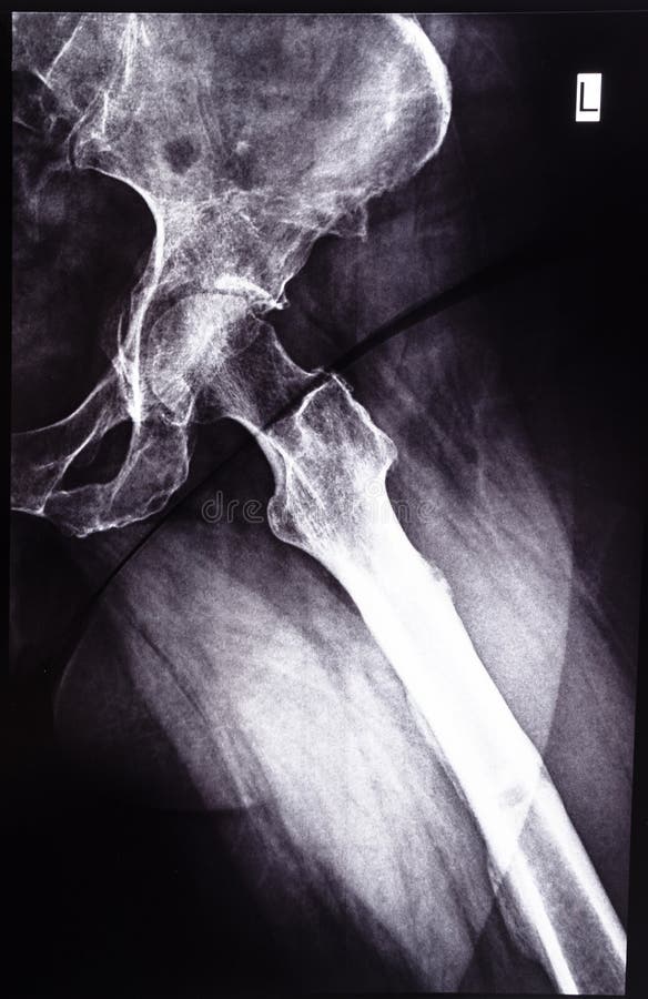 Negative X-ray of Junction of Tibia and Pelvis Stock Image - Image of ...