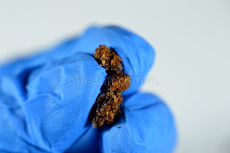 Nephrolithiasis, Irregular Brown Kidney Stones (renal Calculus or ...