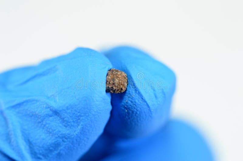 Nephrolithiasis, Irregular Brown Kidney Stones (renal Calculus or ...