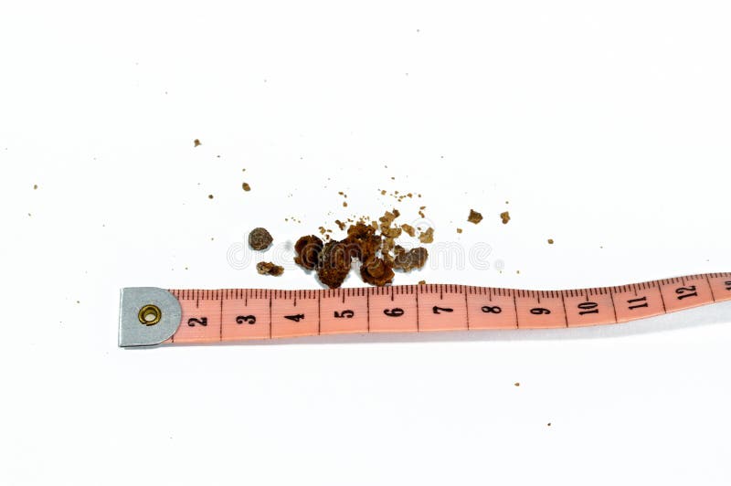 Nephrolithiasis, Irregular Brown Kidney Stones (renal Calculus or ...