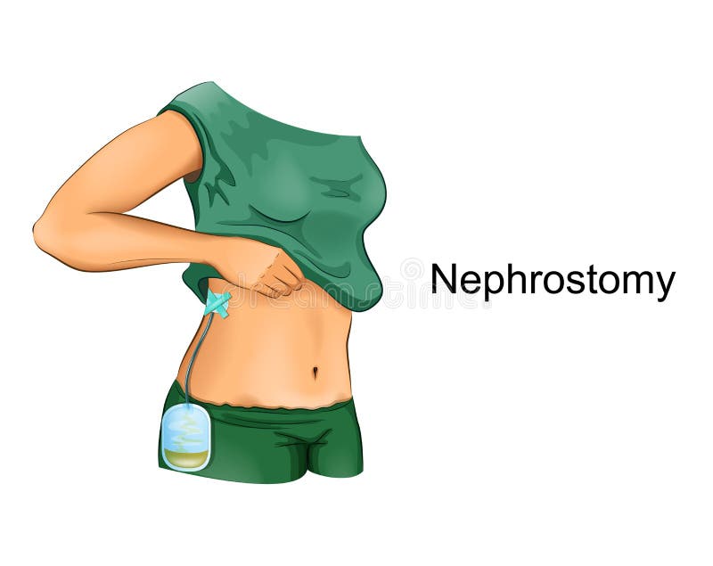 Nephrostomy in the Right Kidney with Drainage Bag Stock Illustration ...