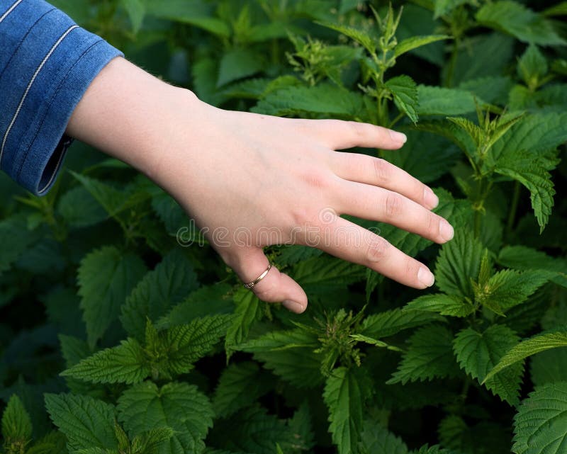 Nettle sting a skin stock photo. Image of allergy, nettle - 10009108