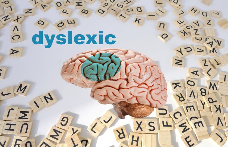Neural Signature in Human Brain for Dyslexia, Disruption of Posterior ... Neural Signature in Human Brain for Dyslexia, Disruption of Posterior ...