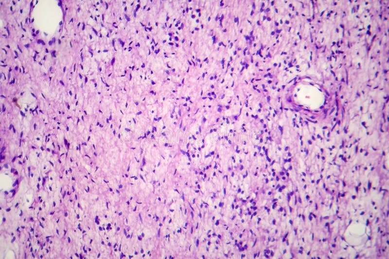 Neurofibromatosis, Light Micrograph, Photo Under Microscope Stock Photo ...