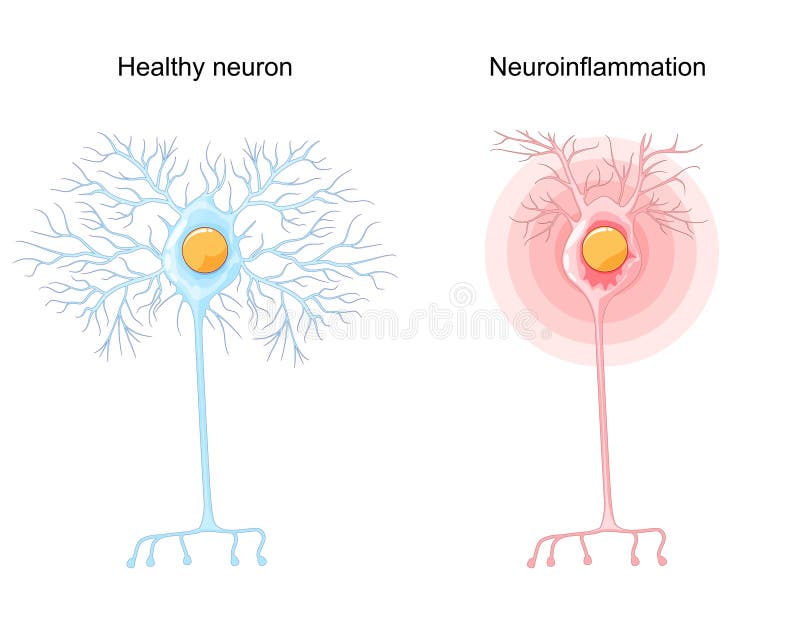 Neuroinflammation Process Stock Illustrations – 7 Neuroinflammation ...