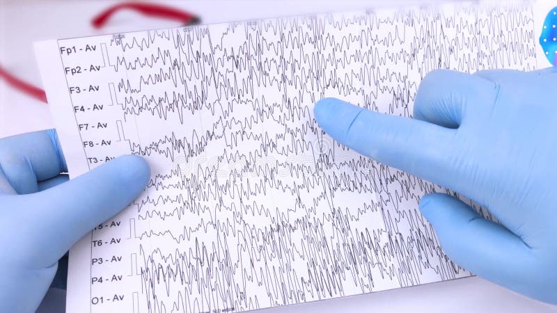 A Neurologist Examines an Encephalogram of a Patient’s Brain. Schedule ...