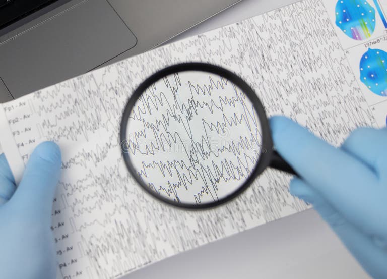 A Neurologist Examines an Encephalogram of a Patientâ€™s Brain ...