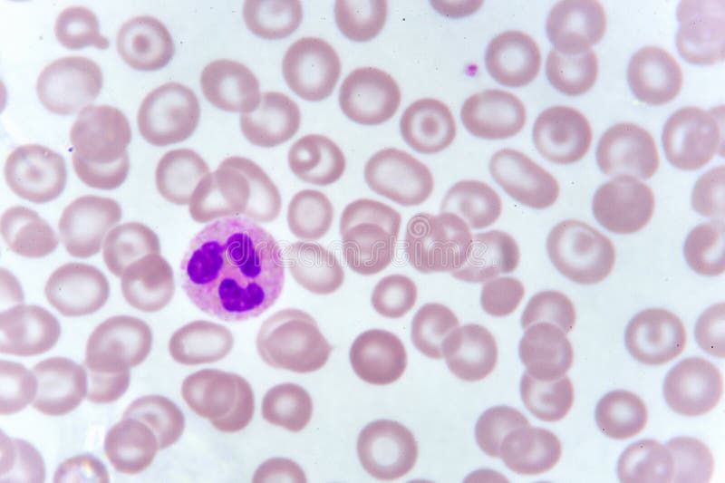 Neutrophil Cell in Blood Smear Stock Photo - Image of pathology ...