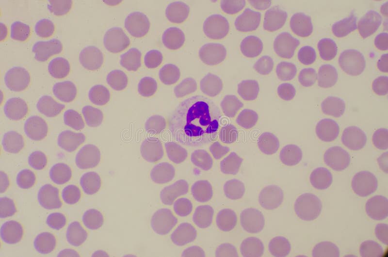 Neutrophil in Sepsis Patein Find with Microscope Stock Photo - Image of ...