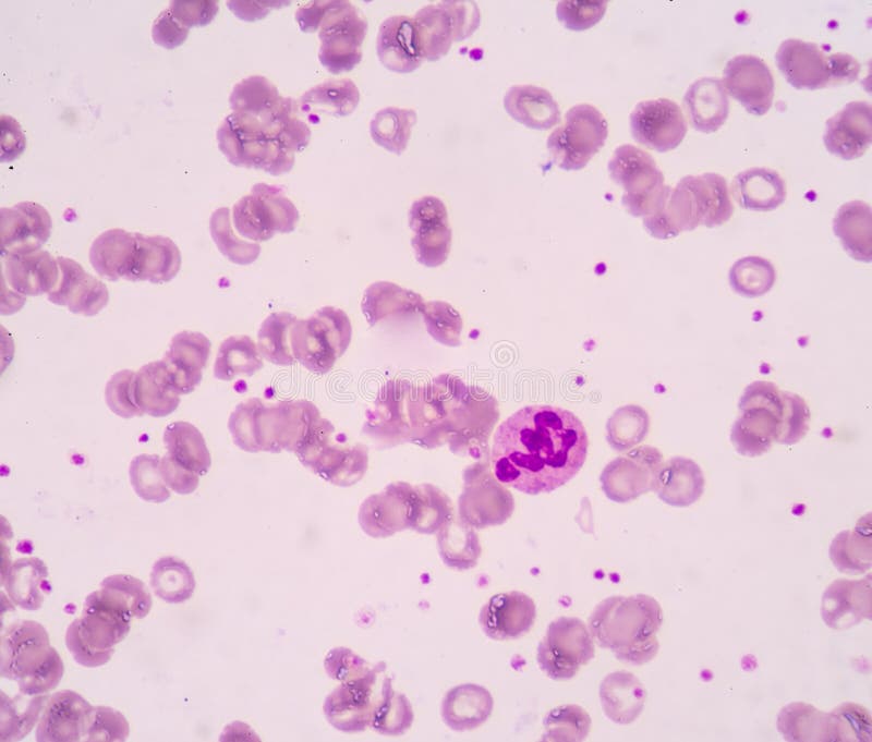 Neutrophile De Hypersegmented Photo stock - Image du organe ...