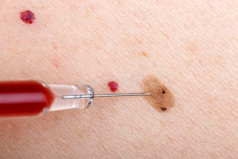 Nevus and Cherry Angioma on Human Skin Stock Photo - Image of ...