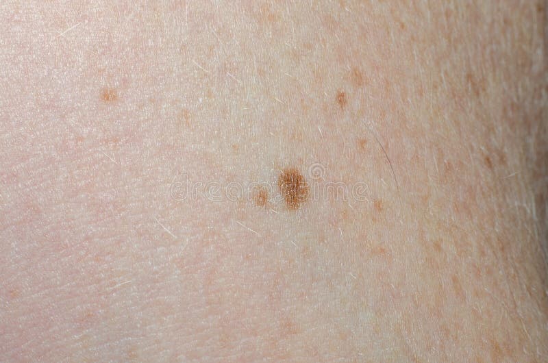 Nevus on Human Skin Close-up Stock Photo - Image of scratch, melanoma ...