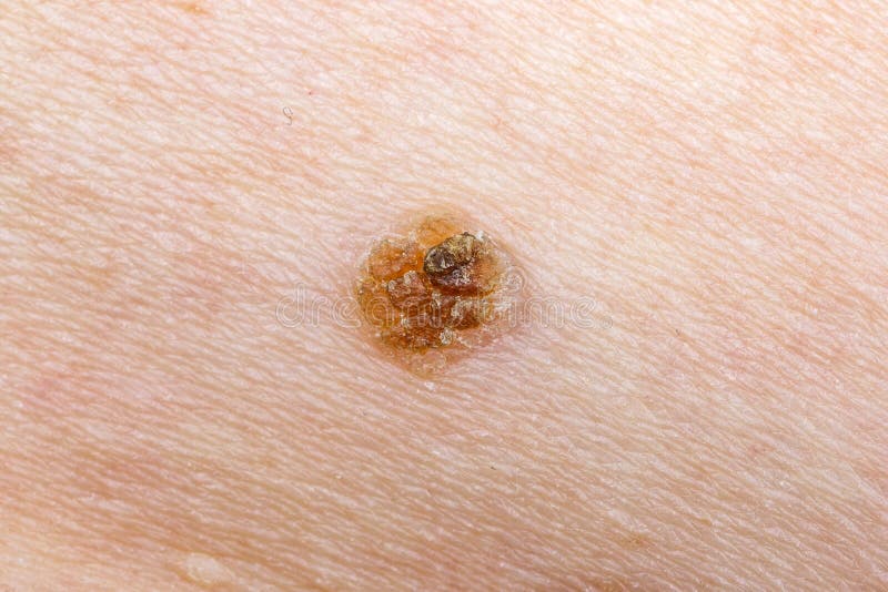 Nevus and Cherry Angioma on Human Skin Stock Photo - Image of ...