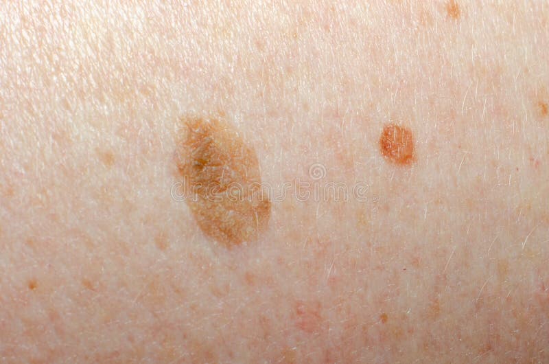 Nevus on Human Skin Closeup Stock Image - Image of nevus, basalioma ...