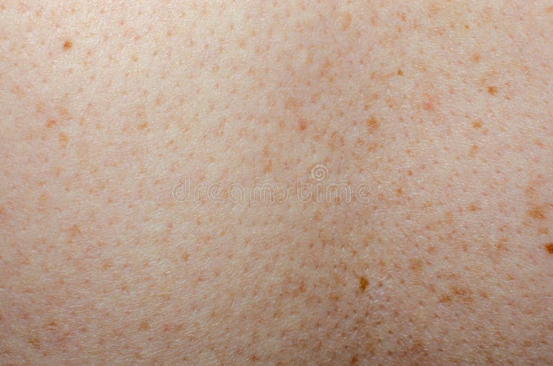 Nevus on Human Skin Closeup Stock Photo - Image of basalioma, nevus ...