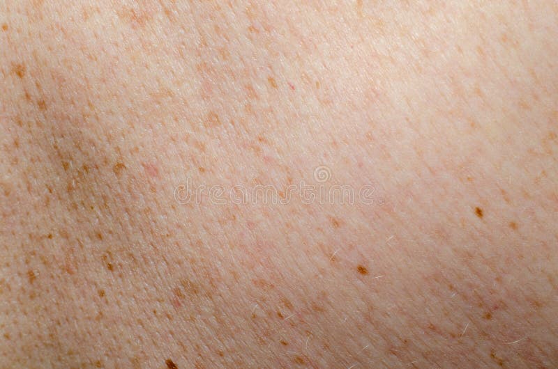 Nevus on Human Skin Closeup Stock Image - Image of mole, skin: 351873293