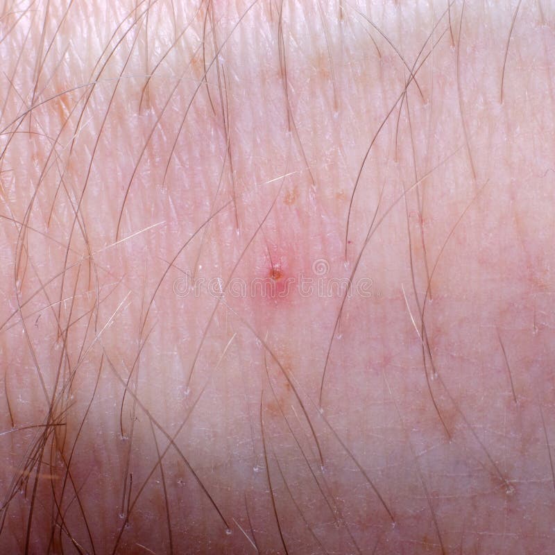 Nevus or Mole on the Human Body Close-up. Skin Cancer, Keratosis or ...