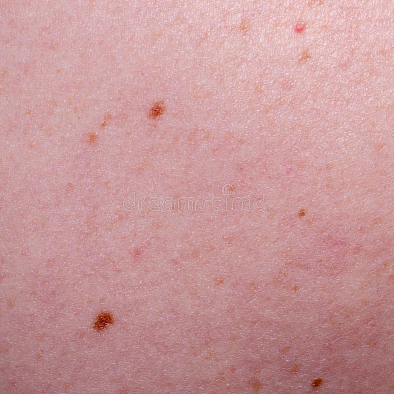 Nevus or Mole on the Human Body Close-up. Skin Cancer, Keratosis or ...