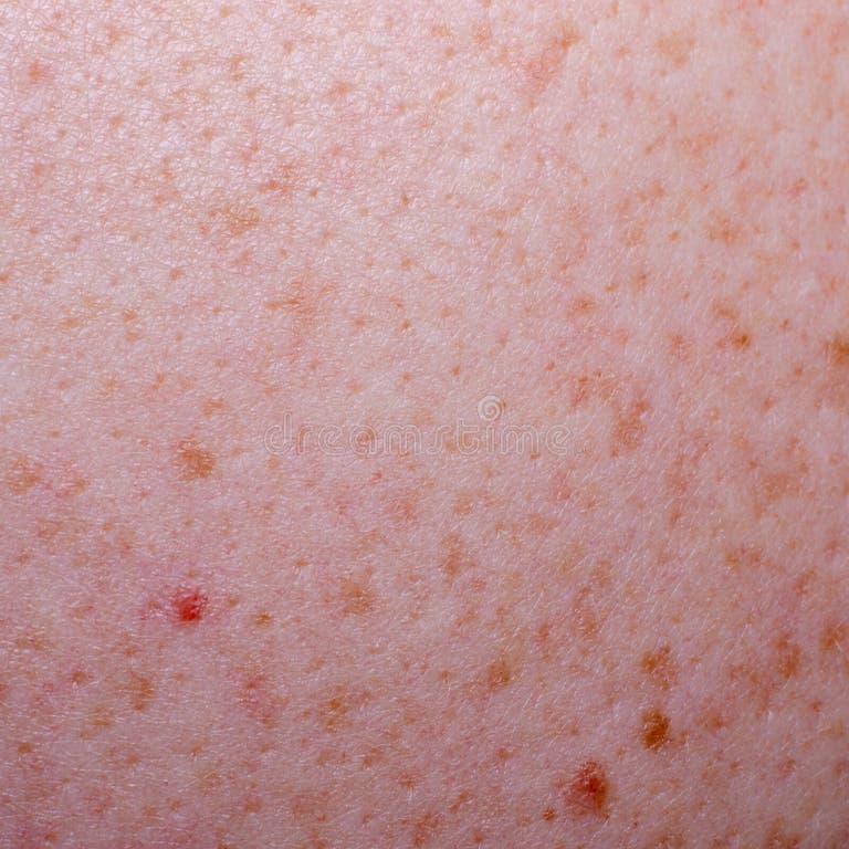 Nevus or Mole on the Skin of Adult Stock Photo - Image of basal ...