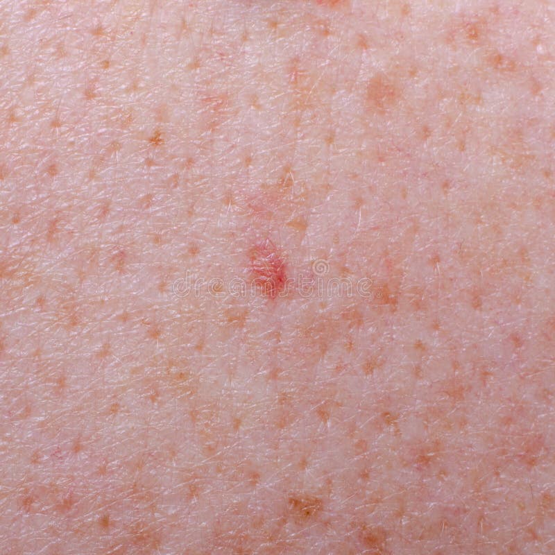 Nevus or Mole on the Human Body Close-up. Skin Cancer, Keratosis or ...