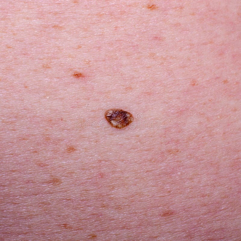 Nevus or Mole on the Human Body Close-up. Skin Cancer, Keratosis or ...