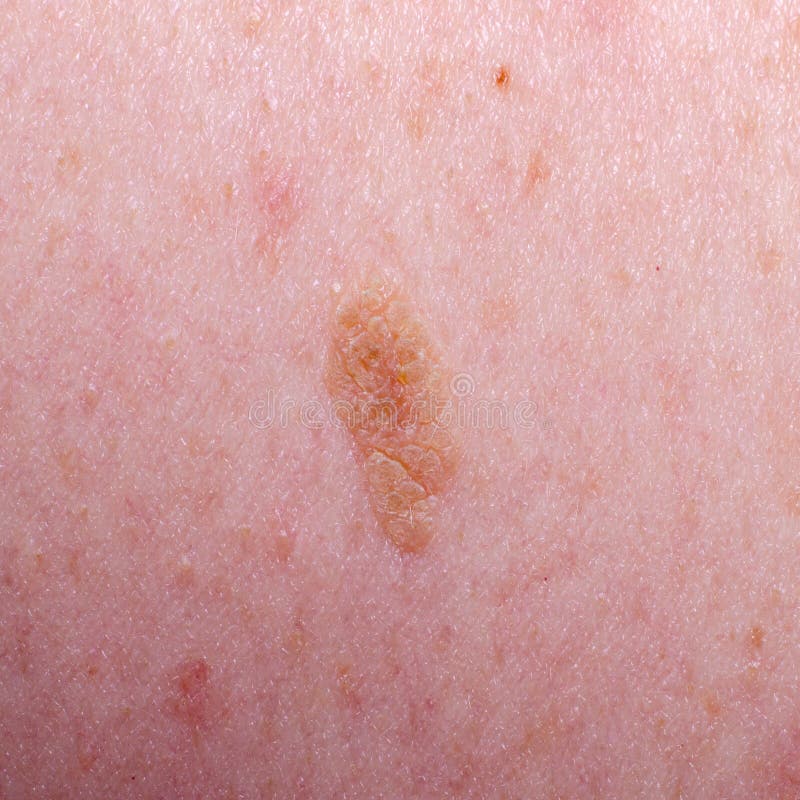 Nevus or Mole on the Human Body Close-up. Skin Cancer, Keratosis or ...