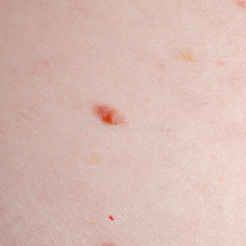 Nevus or Mole on the Skin of the Human Body Close-up Stock Image ...