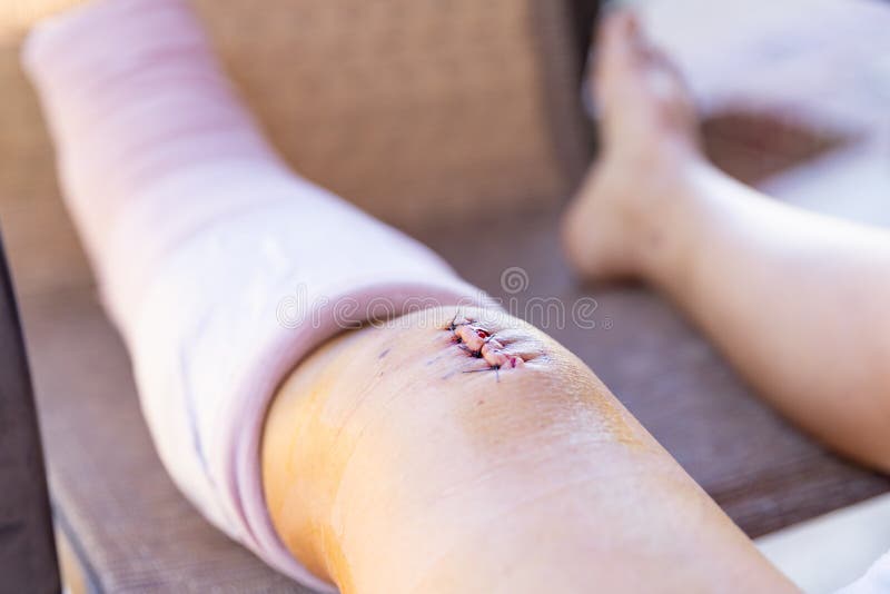 New Incision and Scar after Knee Surgery, Selective Focus Stock Image ...