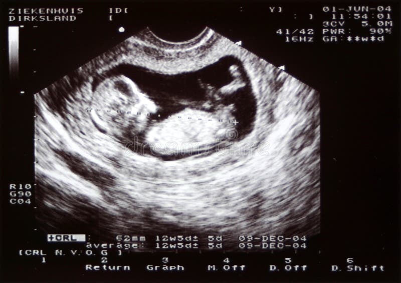 20 Weeks Ultrasound Pictures