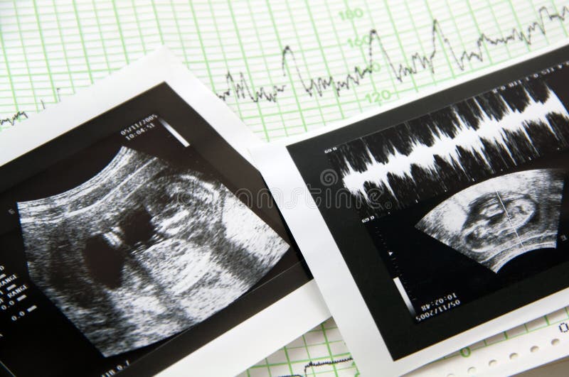 New life, ecografy stock image. Image of fetus, heartbeat - 15318445
