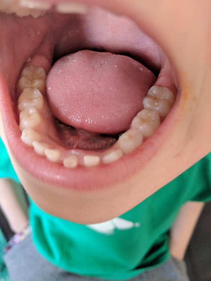 New Teeth Coming in for Young Boy Stock Image - Image of face, tooth ...