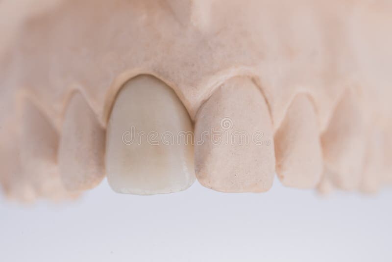 New White Ceramic Dentures on a Light Background Stock Image - Image of ...