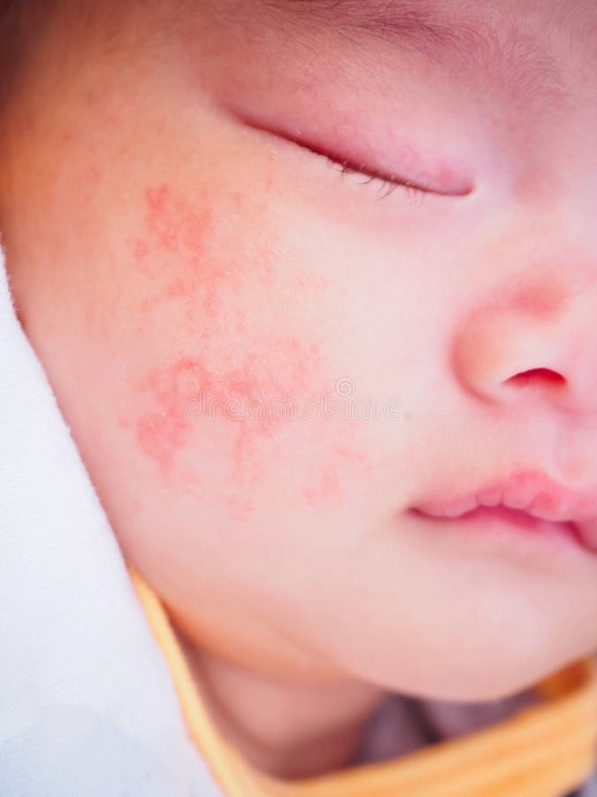 Newborn Baby with Allergy on Face Stock Photo - Image of food, baby ...