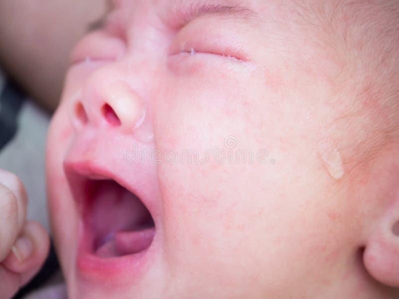 136 Rash Crying Stock Photos - Free & Royalty-Free Stock Photos from ...
