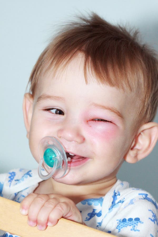 Newborn with red eye stock photo. Image of bacteria, medical - 27342118