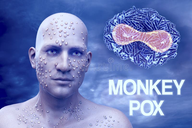 Patient with Monkeypox and Close-up View of Monkeypox Virus, 3D ...
