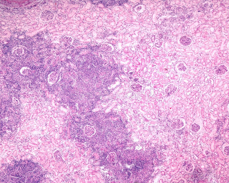 Nier Chronische Pyelonephritis Stock Foto - Image of schip, epitheliaal ...