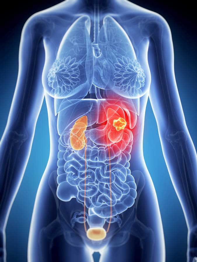 Nierkanker stock illustratie. Illustration of long, maag - 30726923