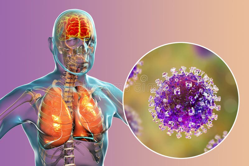 Nipah Virus, Newly Emerging Zoonotic Infection With Respiratory ... Nipah Virus, Newly Emerging Zoonotic Infection With Respiratory ...