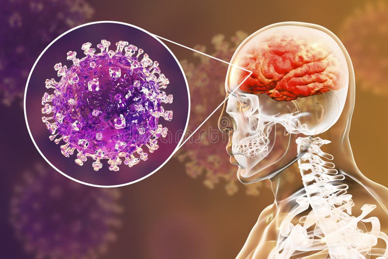 Nipah Virus, Newly Emerging Zoonotic Infection with Respiratory ... Nipah Virus, Newly Emerging Zoonotic Infection with Respiratory ...