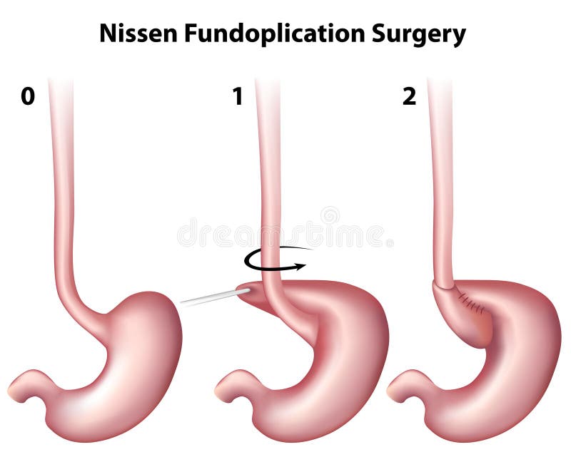 Nissen Fundoplication Surgery Stock Vector - Illustration of human ...