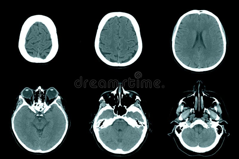 Normaal Hoofd Op CT Aftasten Stock Afbeelding - Image of gezicht ...