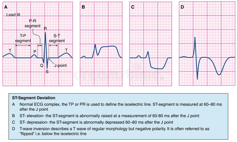 Abnormal Ecg Stock Illustrations – 320 Abnormal Ecg Stock Illustrations ...