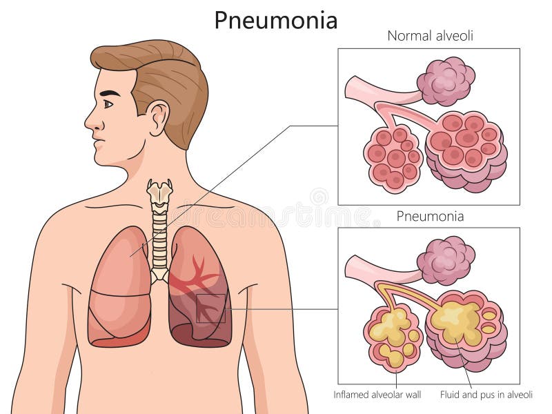 Pneumonia in Human Lungs Diagram Medical Science Stock Illustration ... Pneumonia in Human Lungs Diagram Medical Science Stock Illustration ...