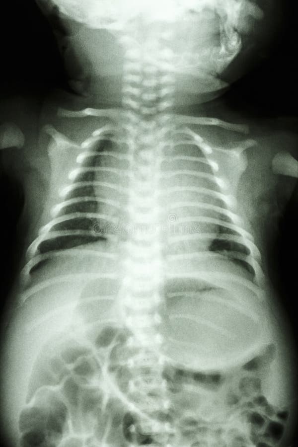 Normal Chest X-ray of Old Patient . You Can Seen Calcification at Rib ...