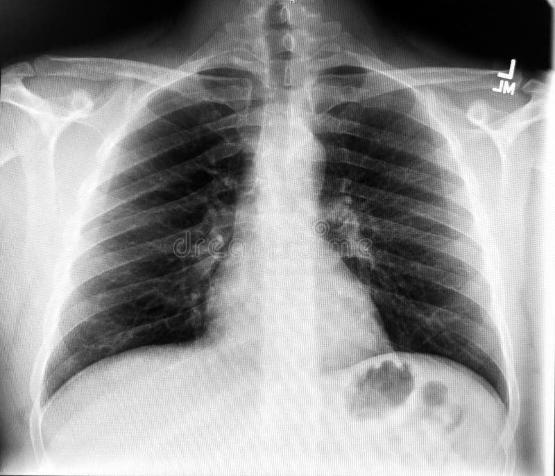 Normal Chest X-Ray - Black and White Radiograph Stock Photo - Image of ...