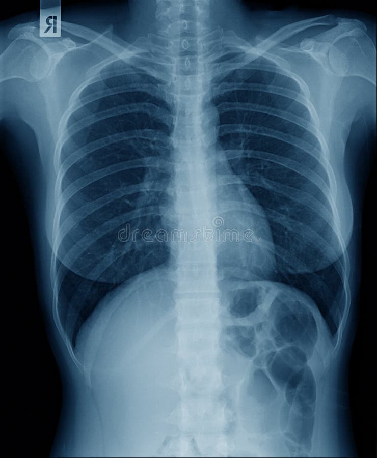 Chest X-ray Image in Blue Tone Stock Image - Image of laboratory ...