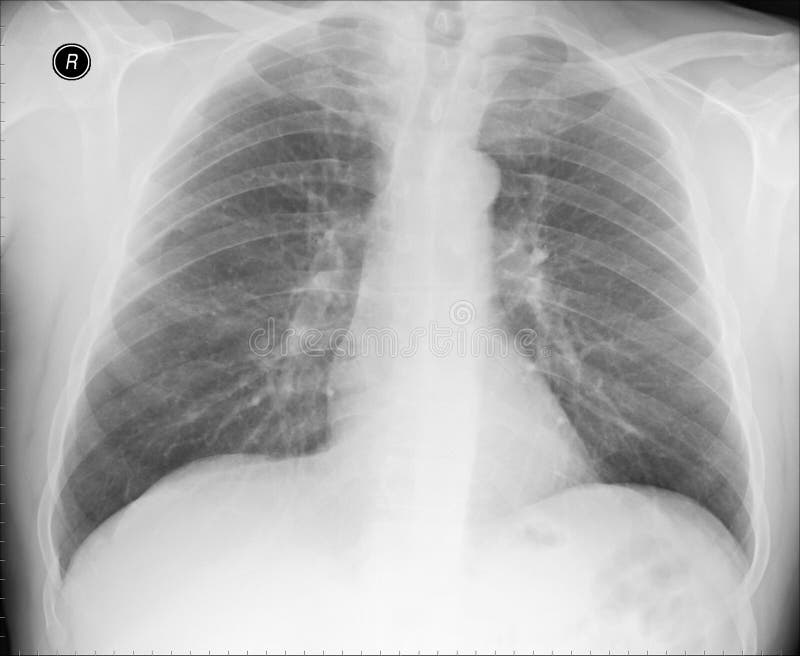 Normal chest X ray stock image. Image of medicine, radiology - 15679493