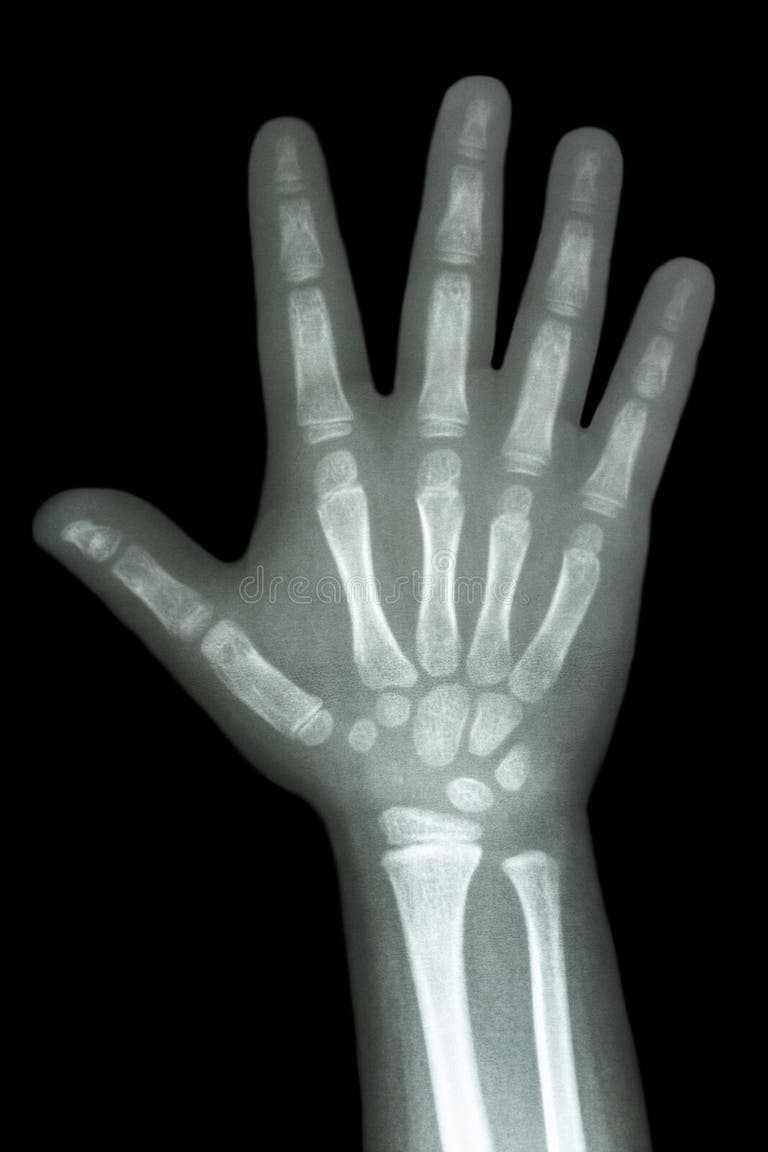 Normal Infant Wrist Xray Stock Photos - Free & Royalty-Free Stock ...